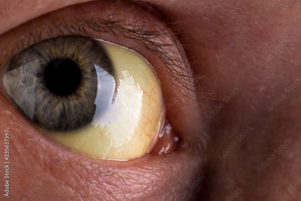 patient with jaundice. close-up shot of yellowed eyes. severe form of ...