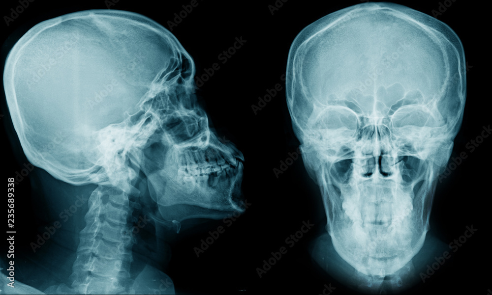 x-ray image lateral and frontal view Stock Photo | Adobe Stock