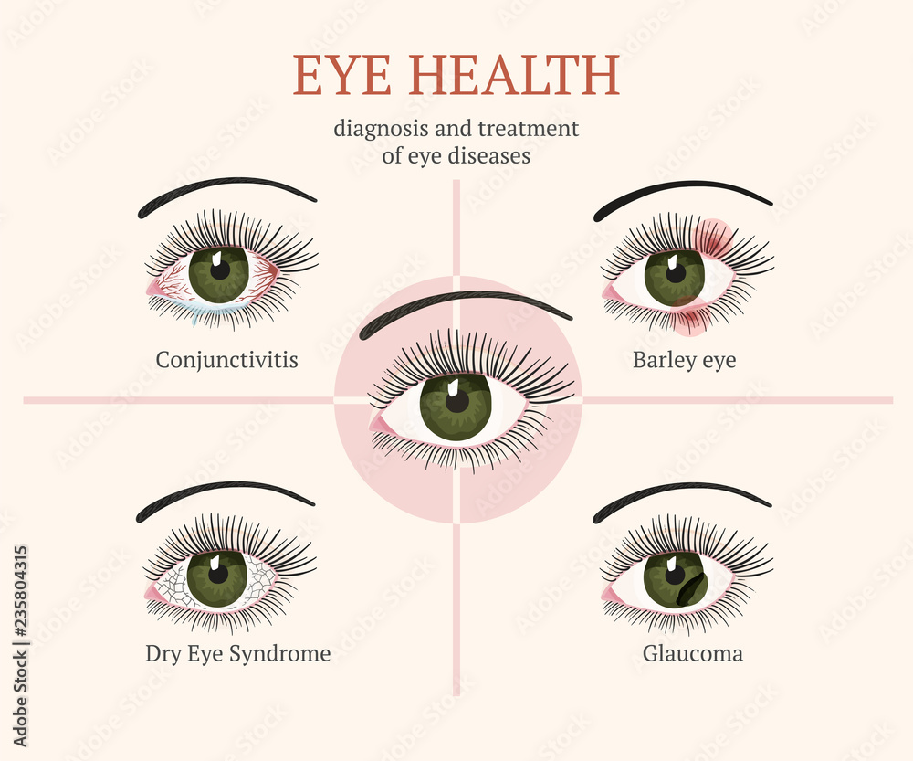 Most common eye problems. Stock Vector | Adobe Stock