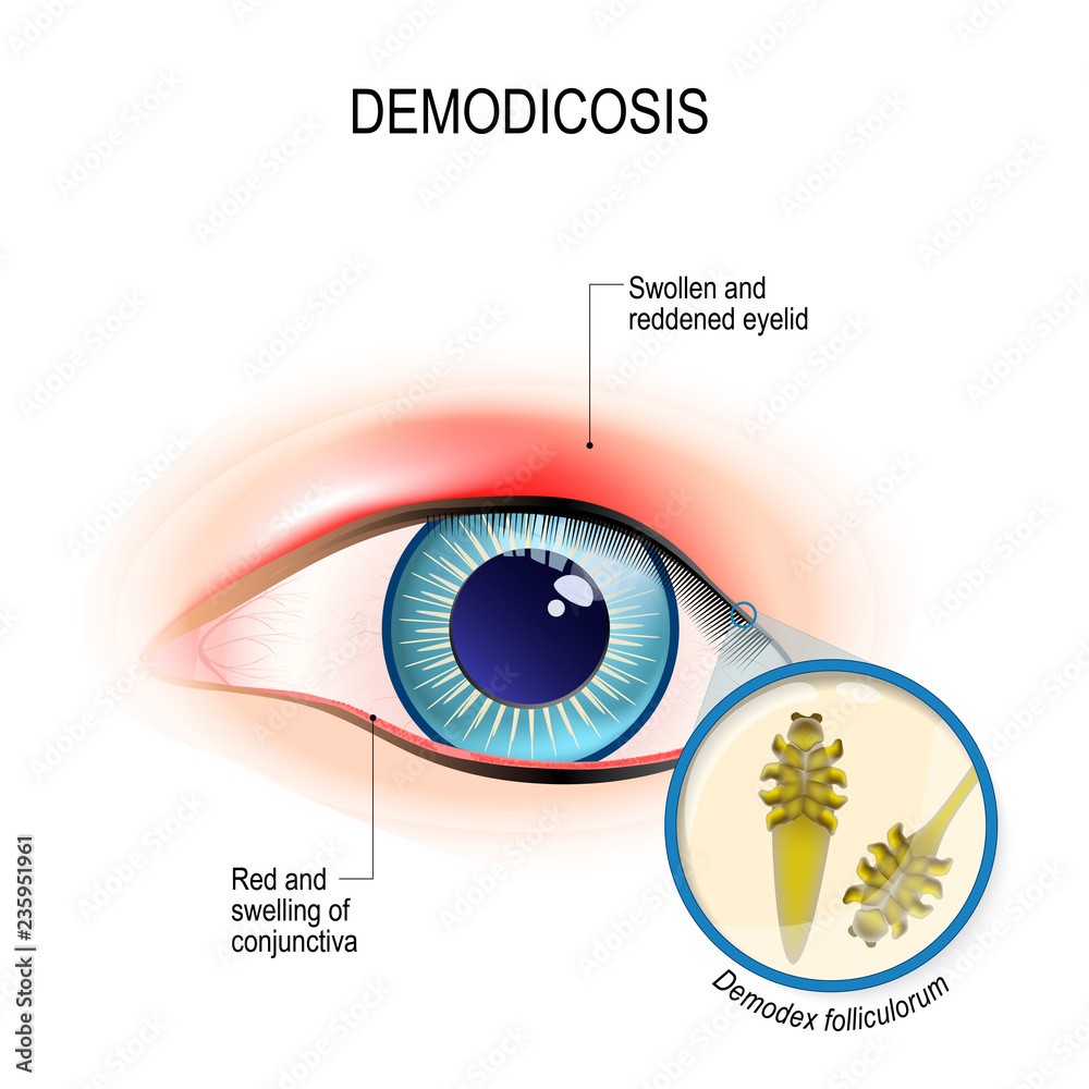 demodicosis of eyelid and red eyes. Close-up demodex through magnifying ...