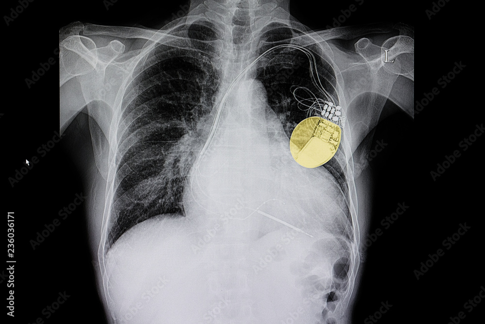 chest film of a patient with cardiac pacemaker Stock Photo | Adobe Stock
