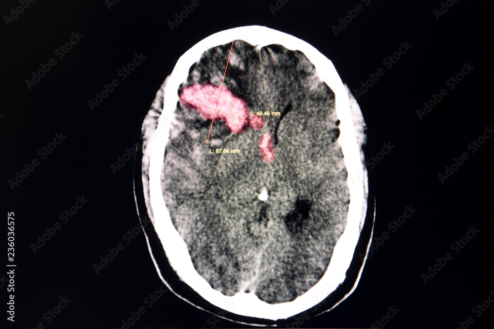 Brain CT scan, intracerebral hemorrhage Stock Photo | Adobe Stock