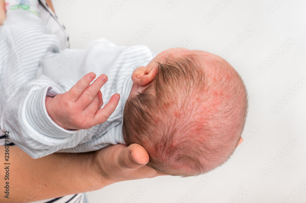 Newborn baby with skin rash. Allergic reaction after birth. Stock Photo ...