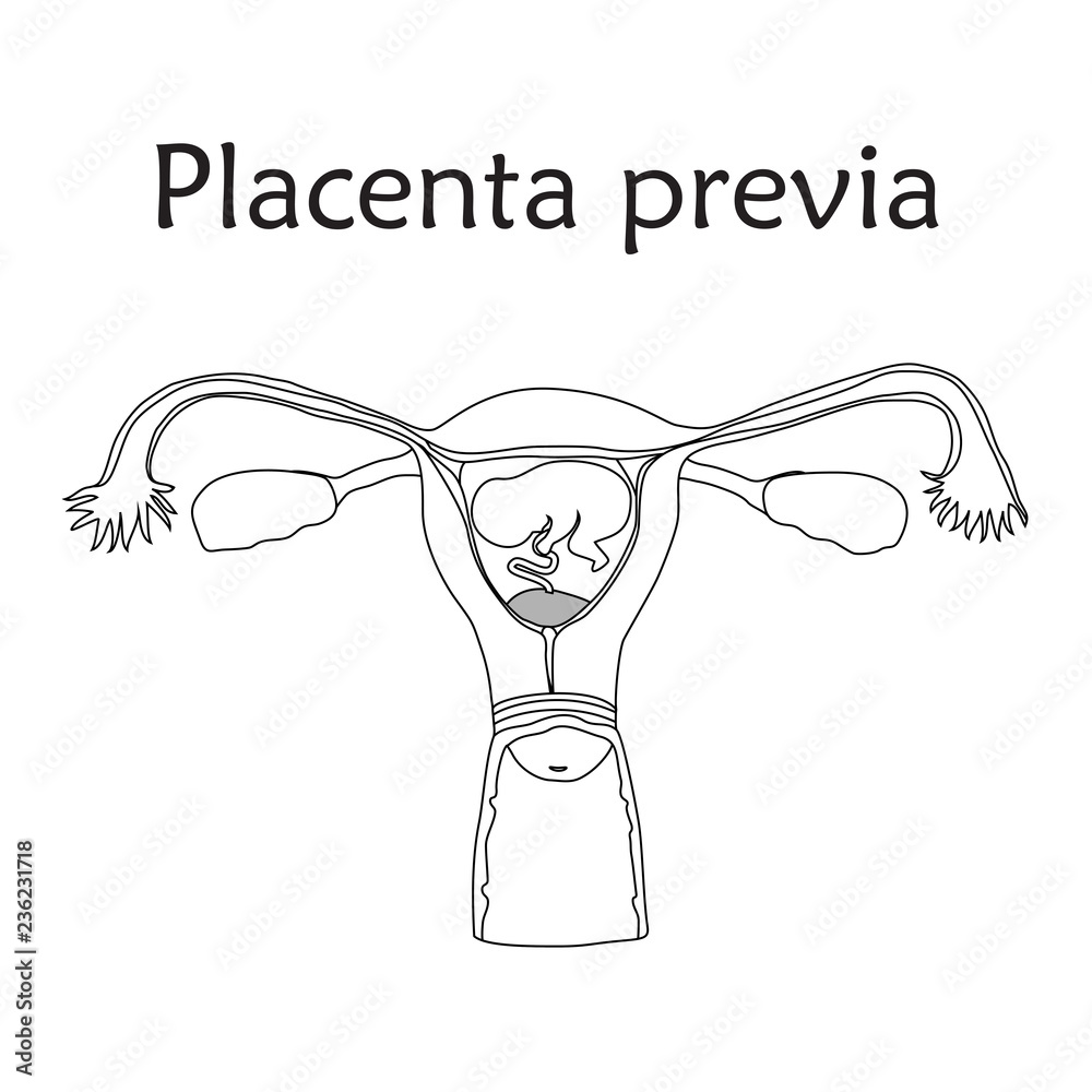Placenta previa. Embryo, fetus in uterus, placenta, umbilical cord ...