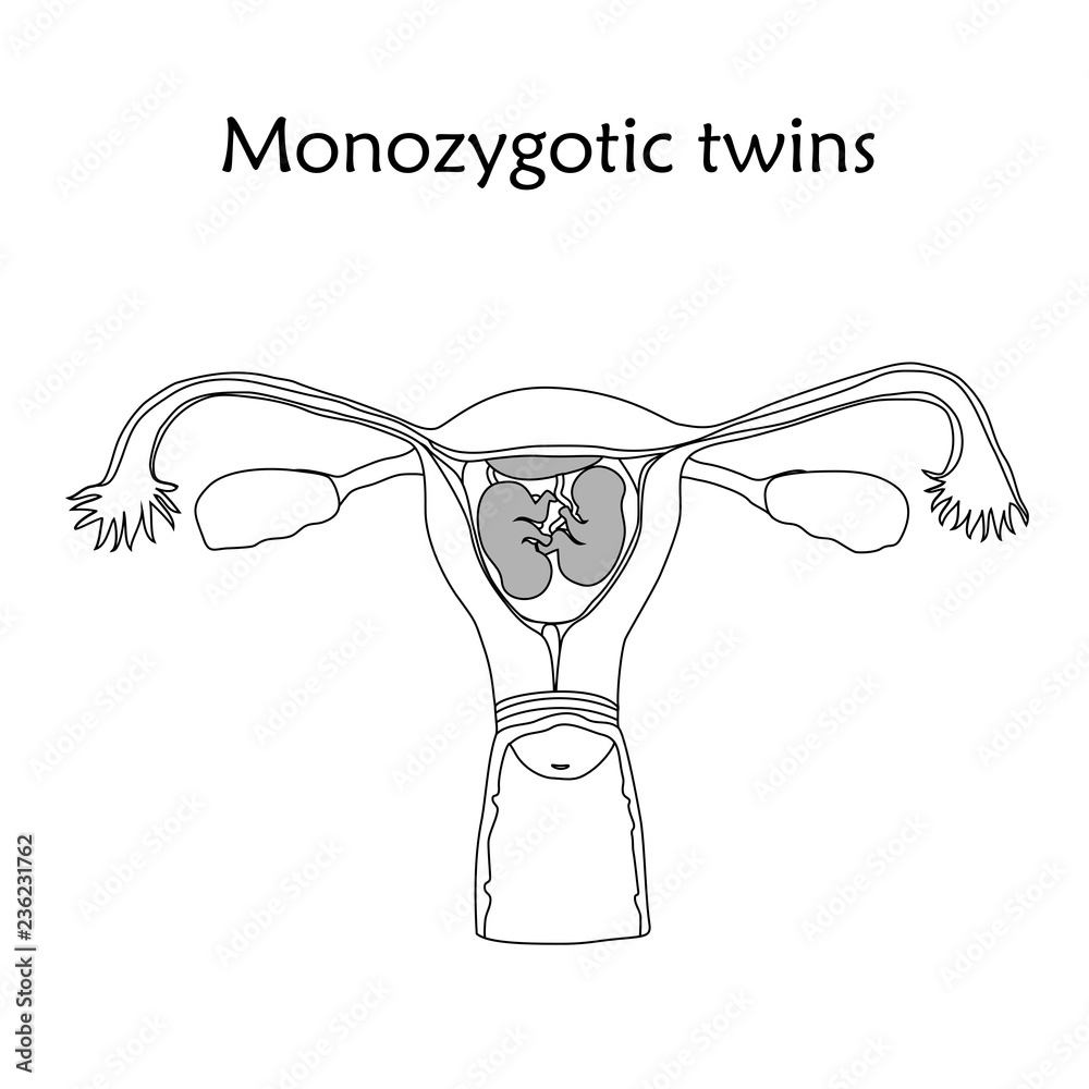 Multiple pregnancy. Monozygotic twins, embryo, fetus in uterus ...