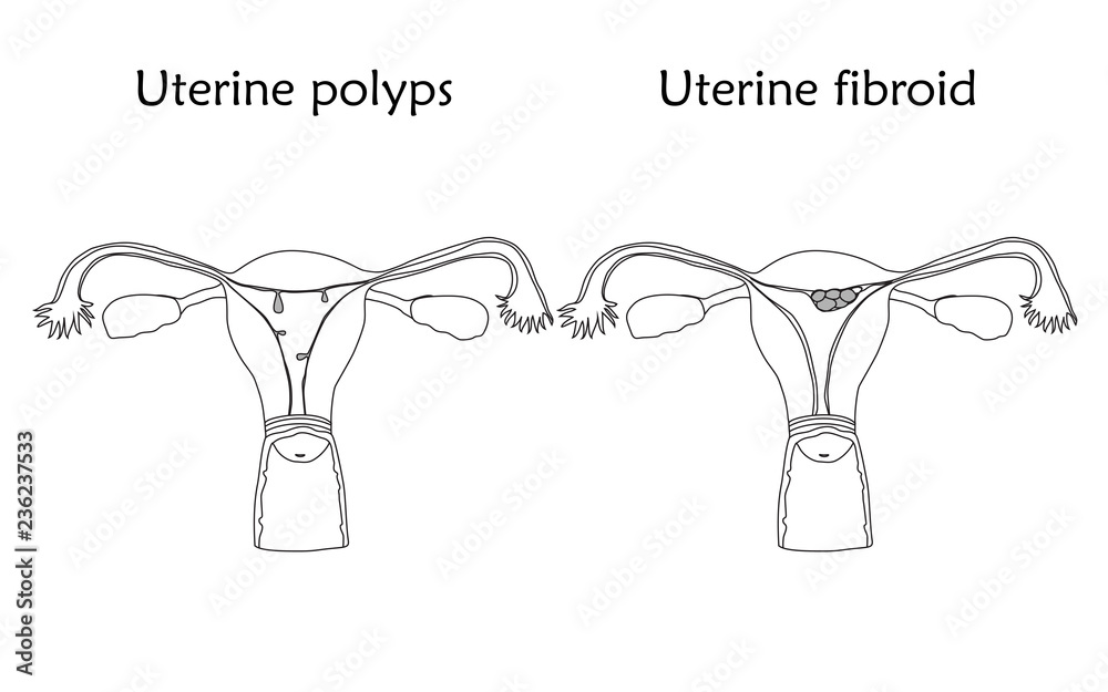 Uterine polyps and uterine fibroid. Human realistic uterus. Anatomy ...