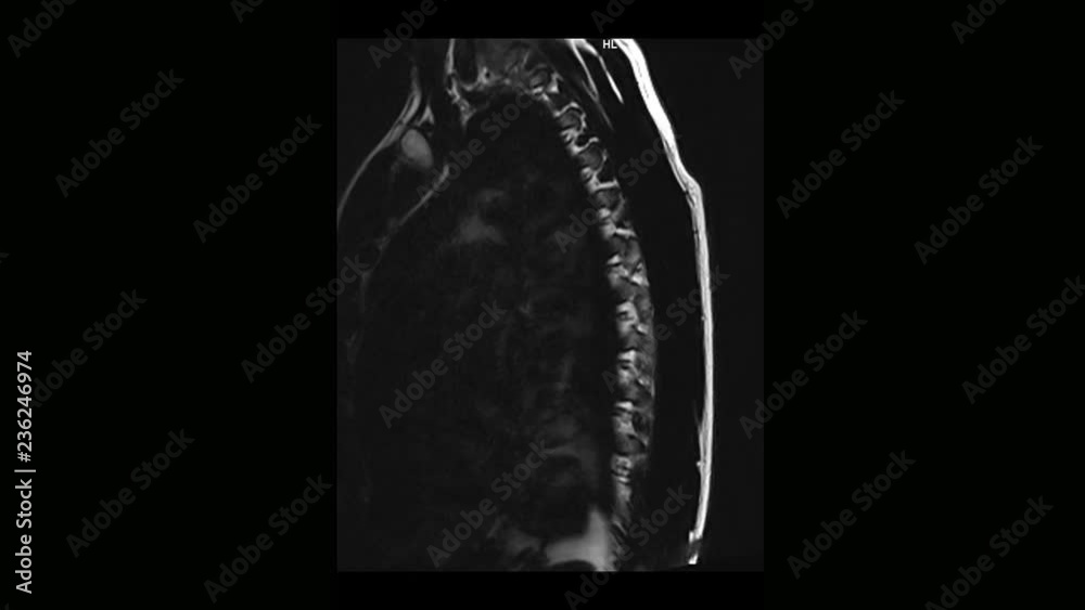 Computed medical tomography MRI scan of the thoracic spine of a man ...