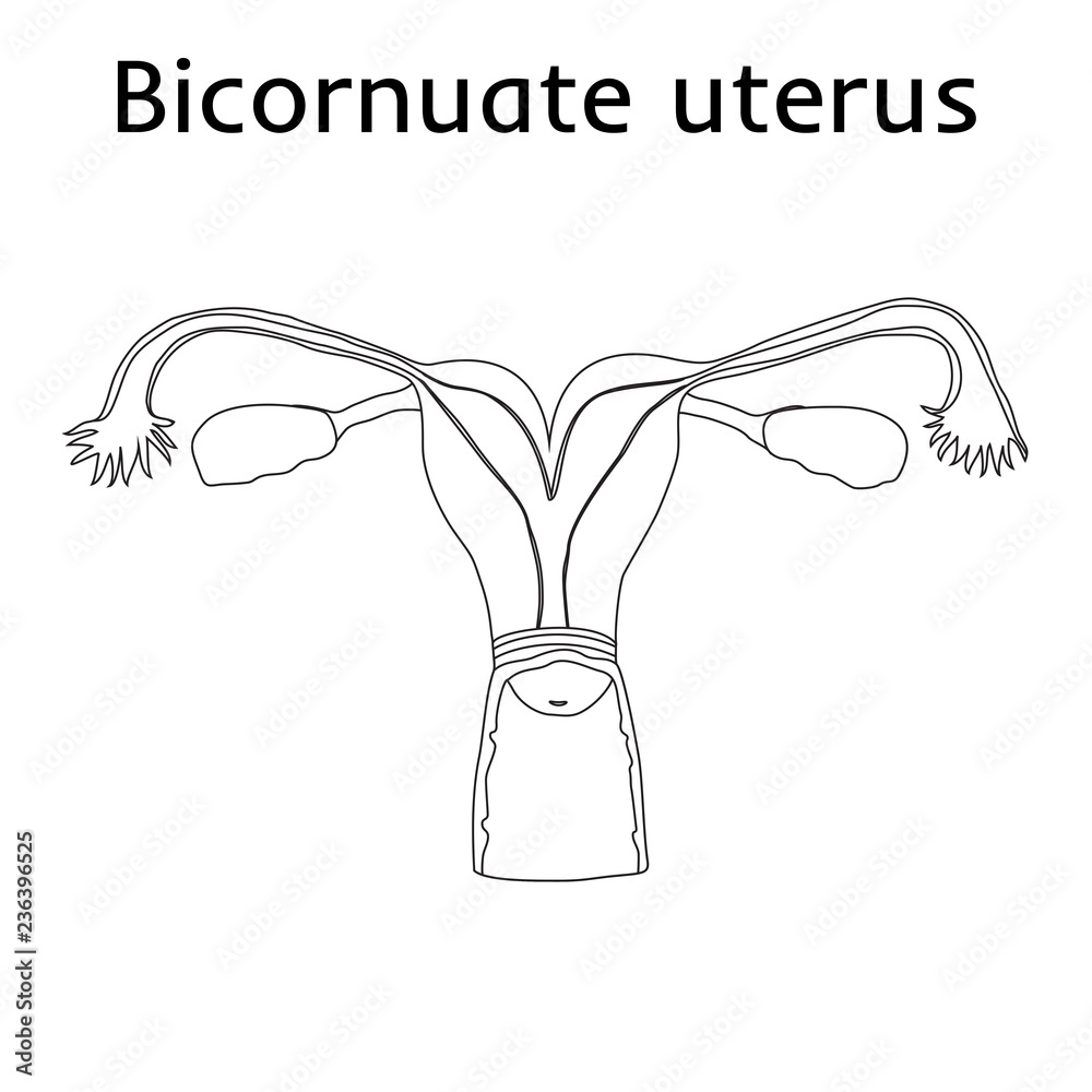 Heart-shaped, becornuate uterus, womb. Uterine abnormalities. White ...