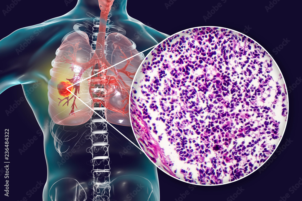 Lung Cancer 3d Illustration And Photo Under Microscope Histopathology Light Micrograph Of