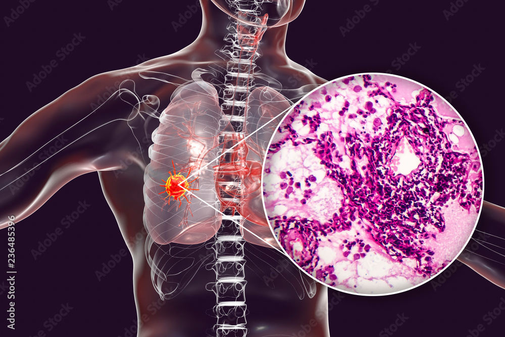 Lung cancer, 3D illustration and photo under microscope. Light ...
