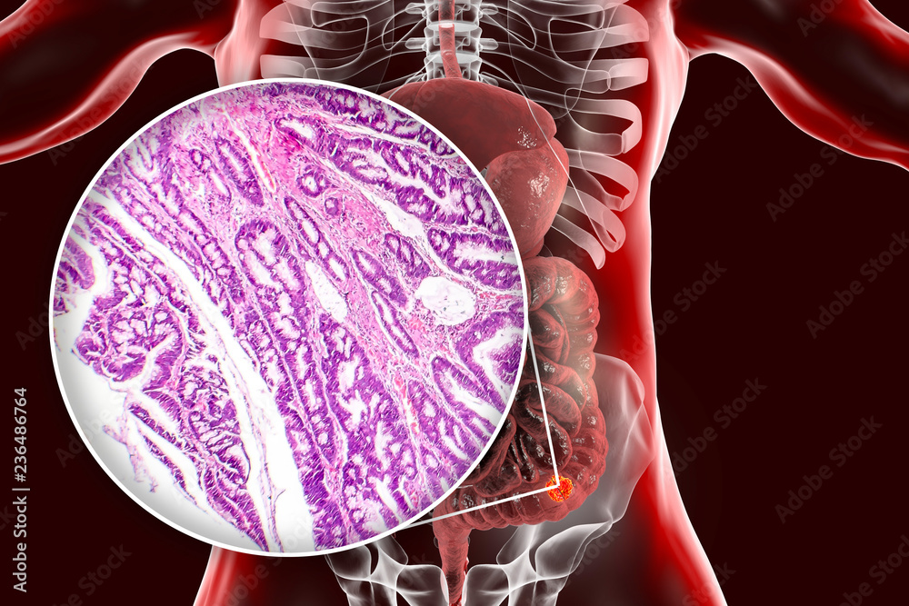 Colon cancer, 3D illustration and photo under microscope. Light ...