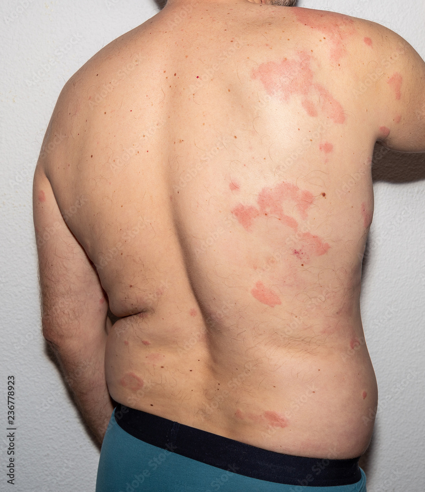 Health. Allergy. Reaction. Histamine. Intolerance Stock Photo | Adobe Stock