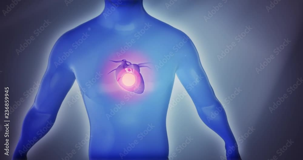 3D anatomy man suffering from heart attack, coronary artery disease ...