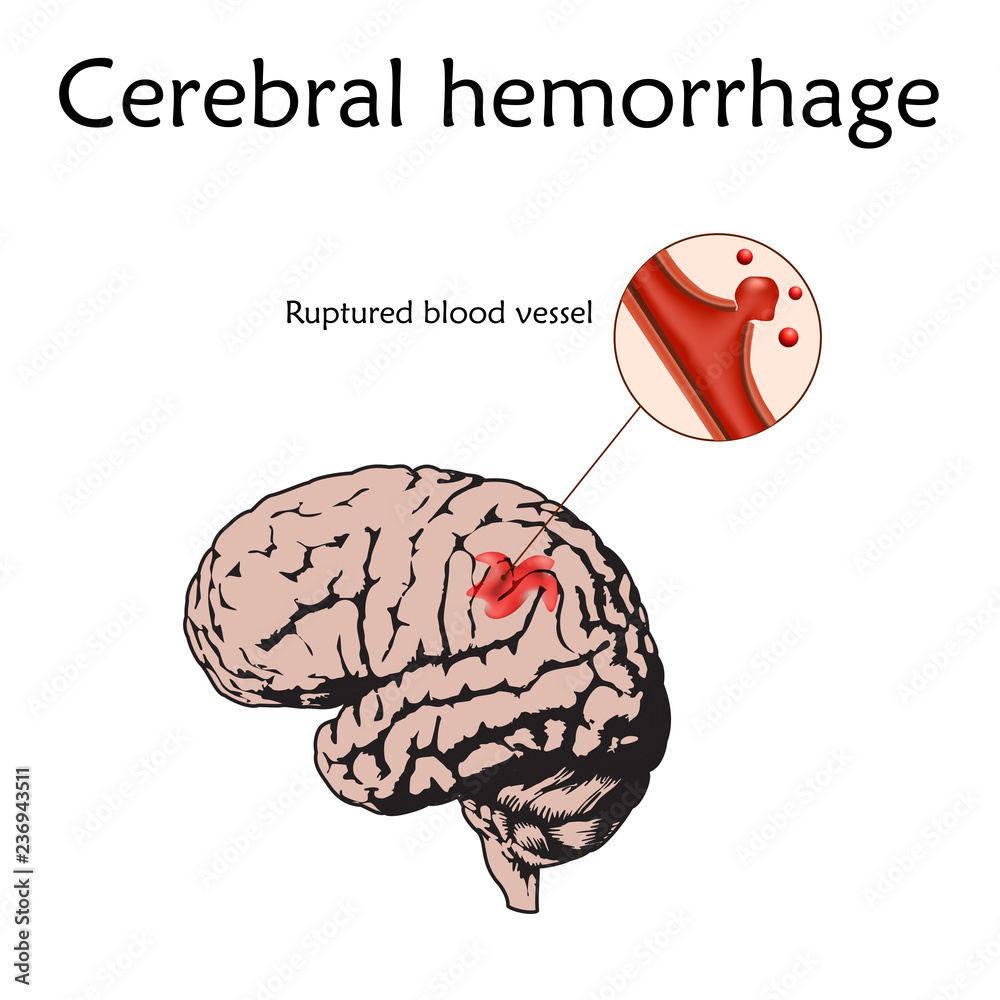 Cerebral hemorrhage poster, banner. Vector medical illustration. white ...