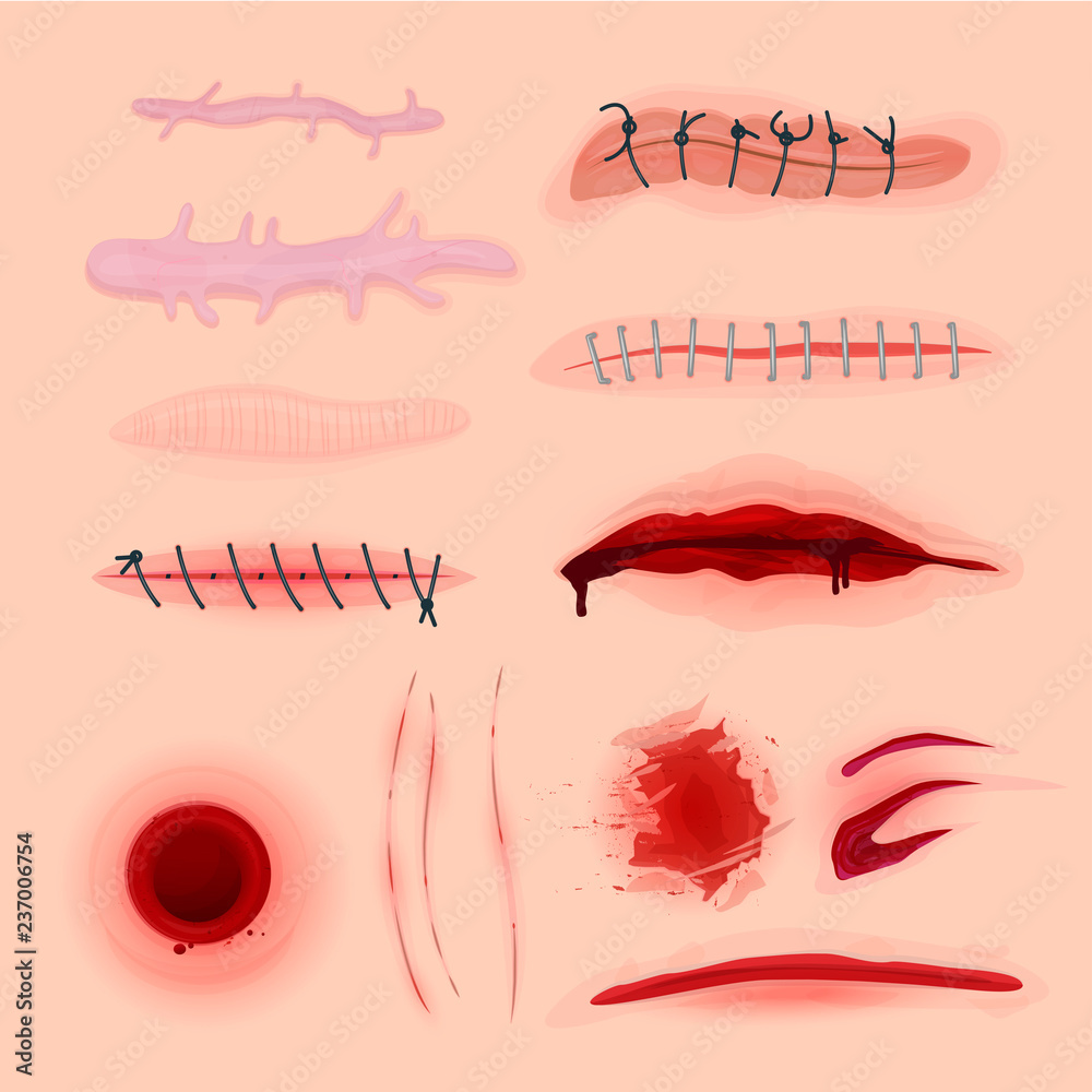 Skin Scars Cuts And Bloody Wounds Set Stock Vector Adobe Stock skin-scars-cuts-and-bloody-wounds-set-stock-vector-adobe-stock