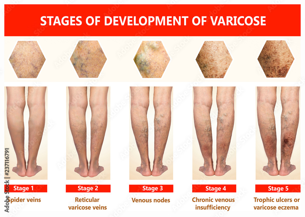 Varicose veins on a female senior legs. The stages of varicose veins ...