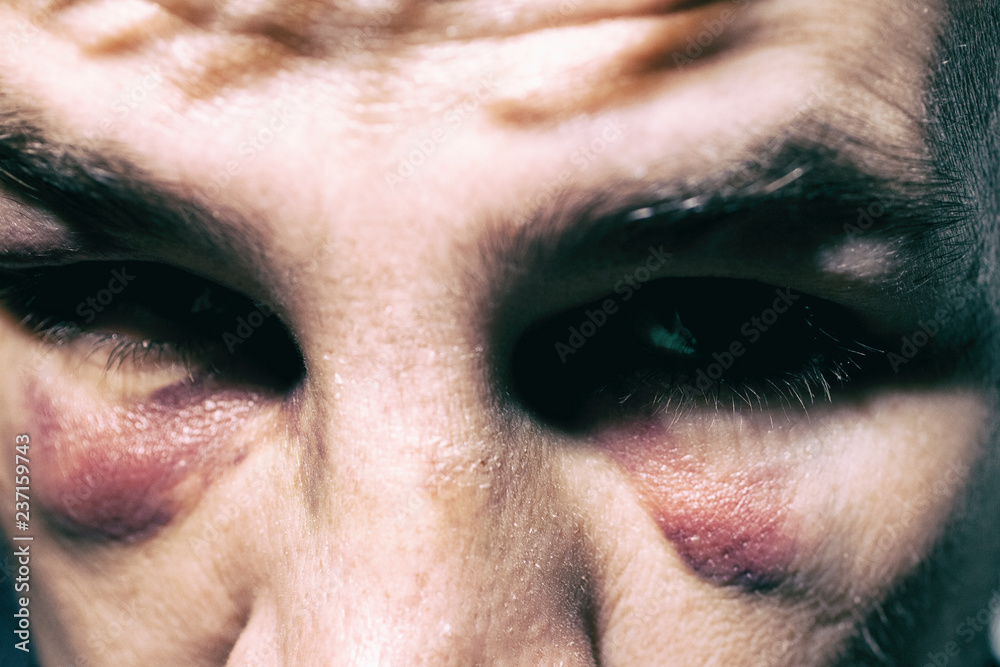 Man's face after the fight and assault. Caucasian male Emotional ...