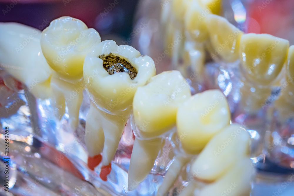 Stockfoto med beskrivningen An example of dental disease. Jaw teeth ...