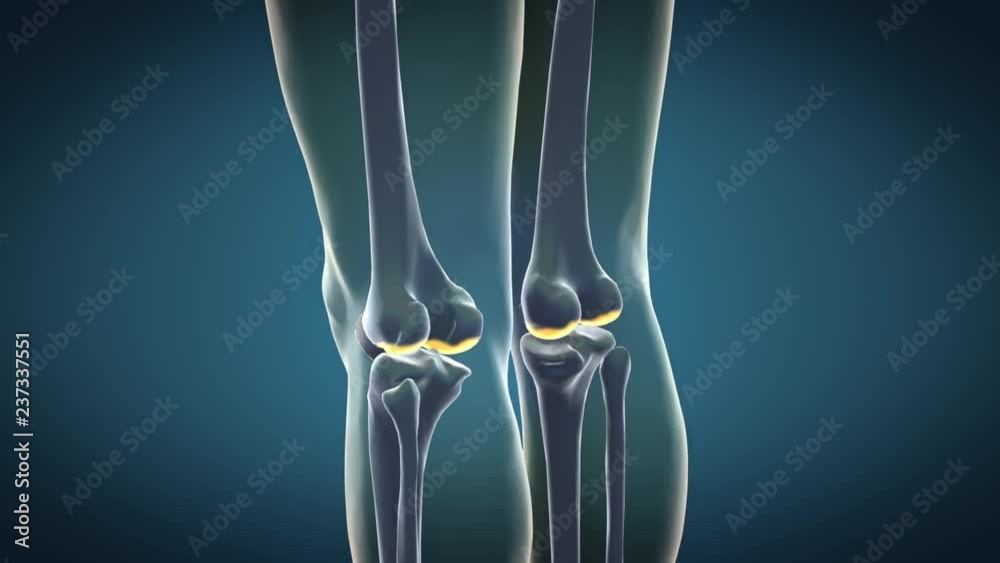 3D rendered shot of knee bone damaged from osteoarthritis was ...