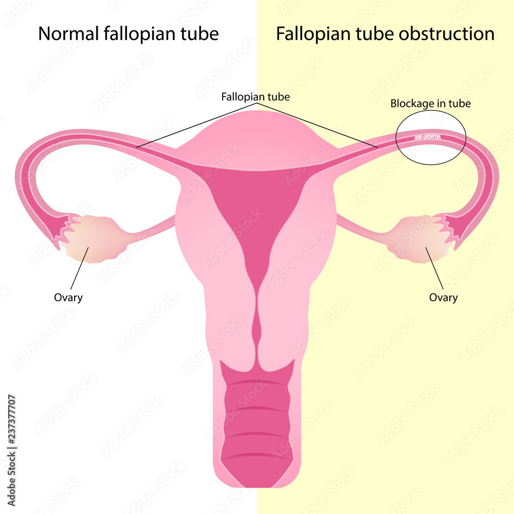 Comparison between normal fallopian tube and fallopian tube obstruction ... Comparison between normal fallopian tube and fallopian tube obstruction ...