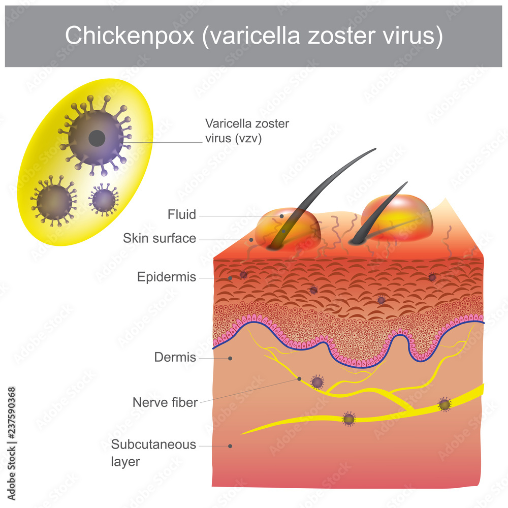 Chickenpox varicella zoster virus. Stock Vector | Adobe Stock