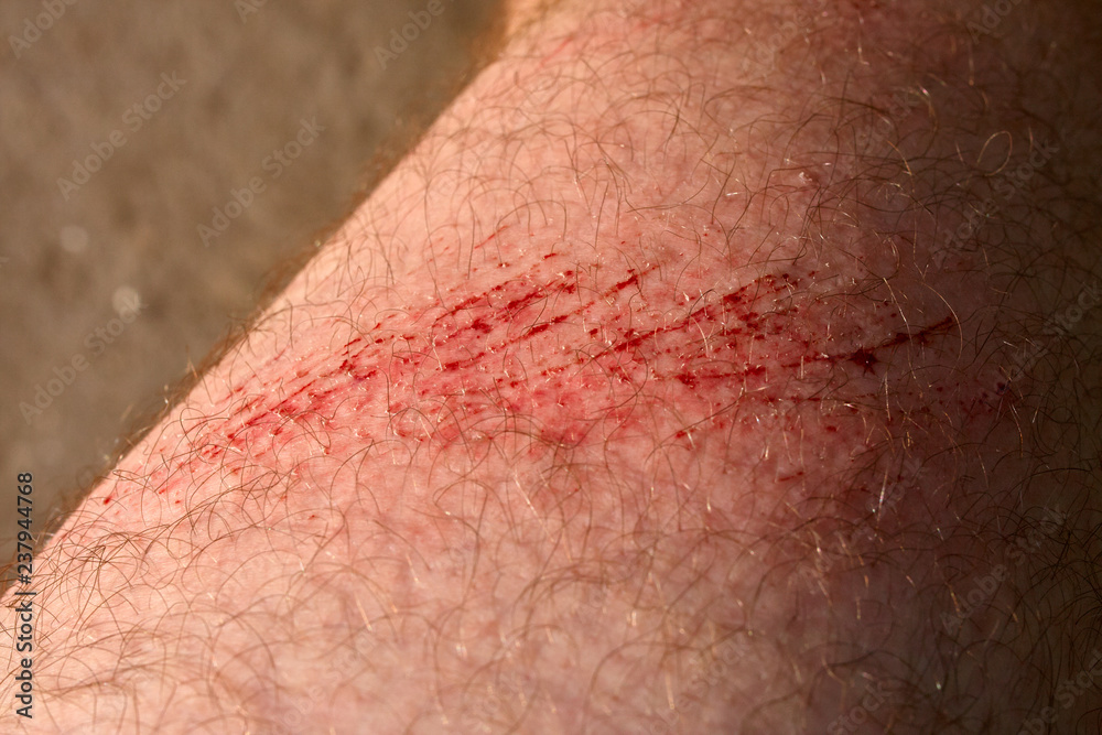 Scratch skin, wound or cut on the skin, red blood. Hairy part of a man ...