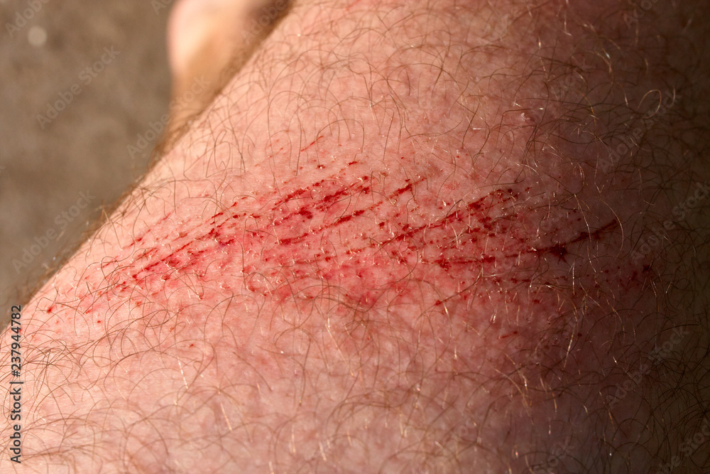 Scratch skin, wound or cut on the skin, red blood. Hairy part of a man ...