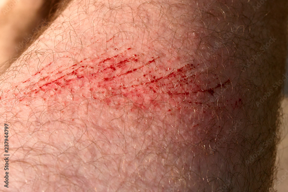 Scratch skin, wound or cut on the skin, red blood. Hairy part of a man ...