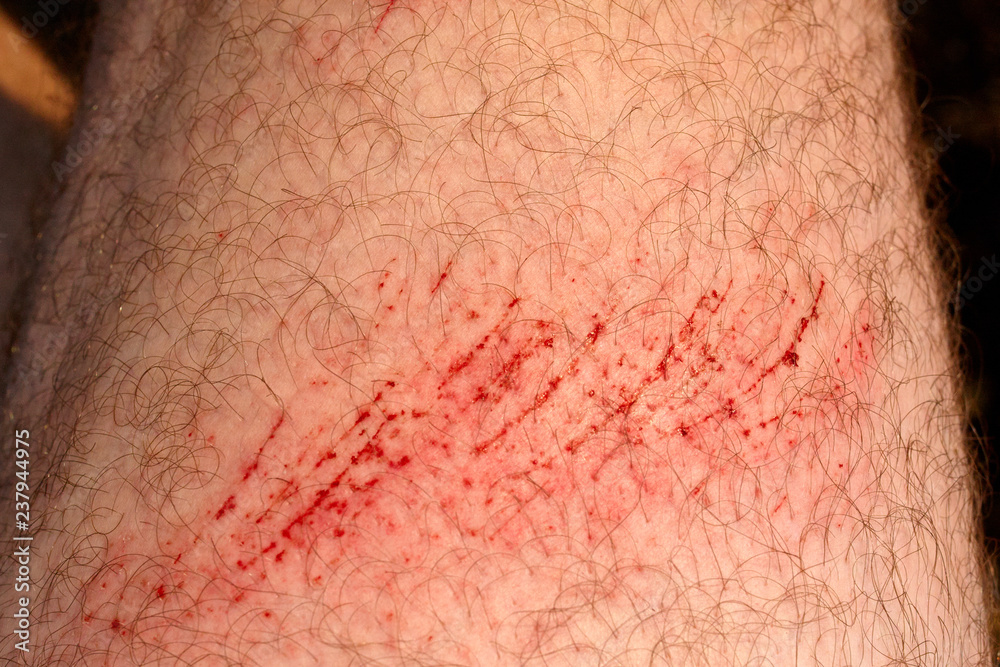Scratch skin, wound or cut on the skin, red blood. Hairy part of a man ...