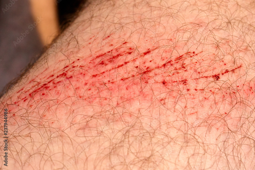 Scratch skin, wound or cut on the skin, red blood. Hairy part of a man ...