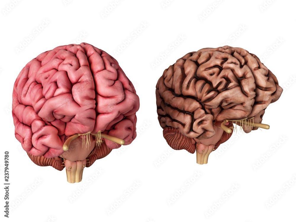 Healthy Vs Unhealthy Brain
