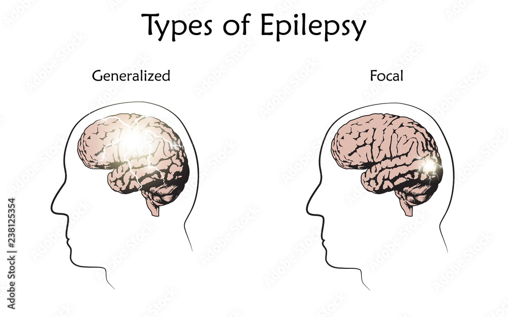 Types of epilepsy. Vector medical illustration. Generalized, focal ...
