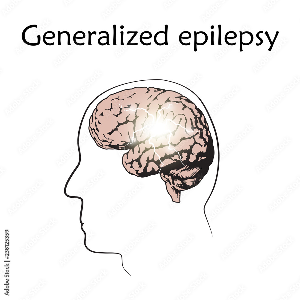 Generalized epilepsy. Vector medical illustration. White background ...