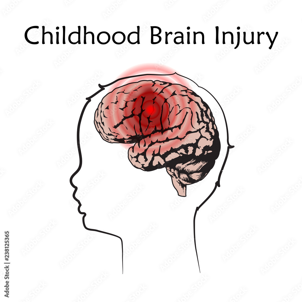 Braim injury in infants, childhood. Vector medical illustration. Kid ...