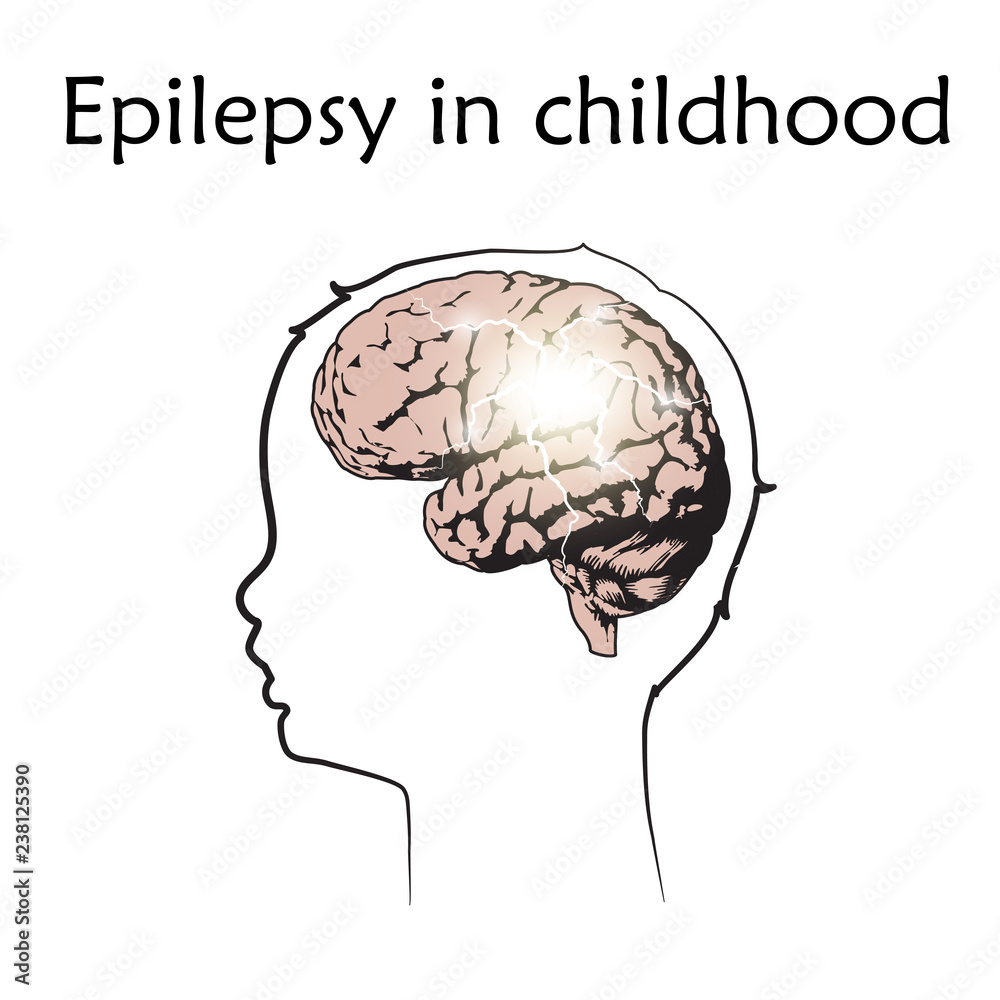 Epilepsy in infants, childhood. Vector medical illustration. Kid, baby ...