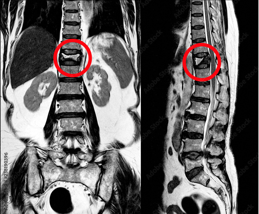 Pathological Fracture Spine
