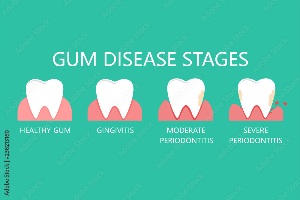 Stomatological concept. The stages of gum disease, the stage of ...