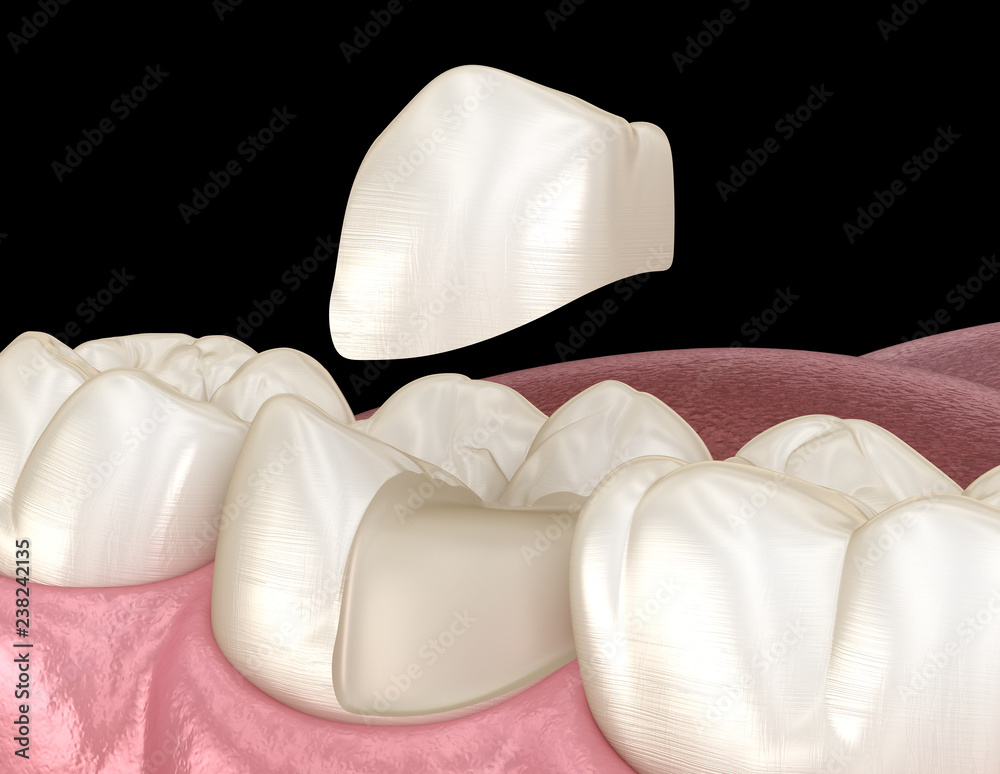 Onlay ceramic crown fixation over tooth. Medically accurate 3D ...