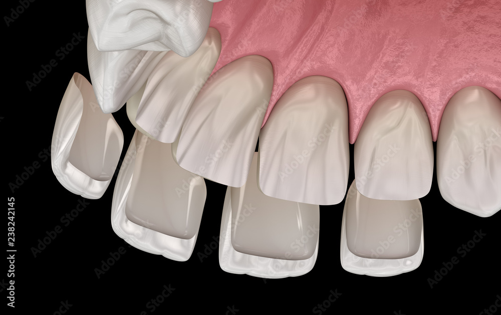 Veneer installation procedure over central incisor and lateral incisor ...