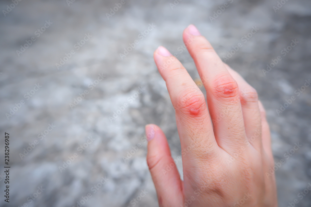 Keloid scar on woman hand. Can use for skin imperfections concepts ...