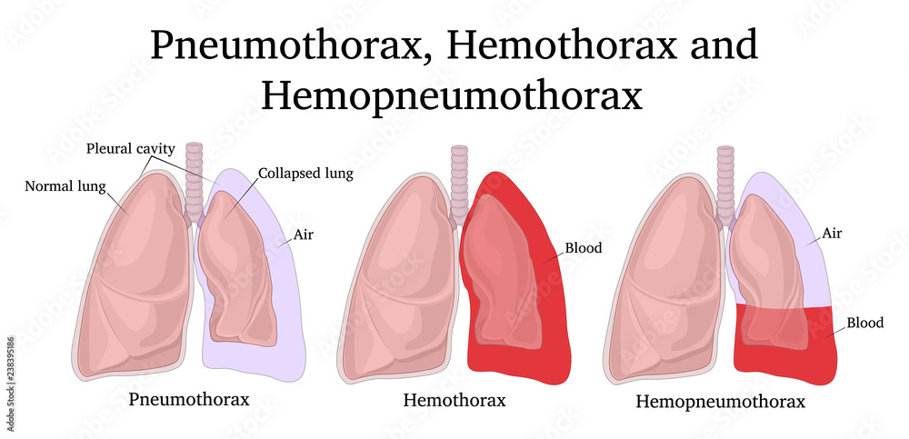 Pneumotórax: O Que É, Sintomas E Tratamento – DZED