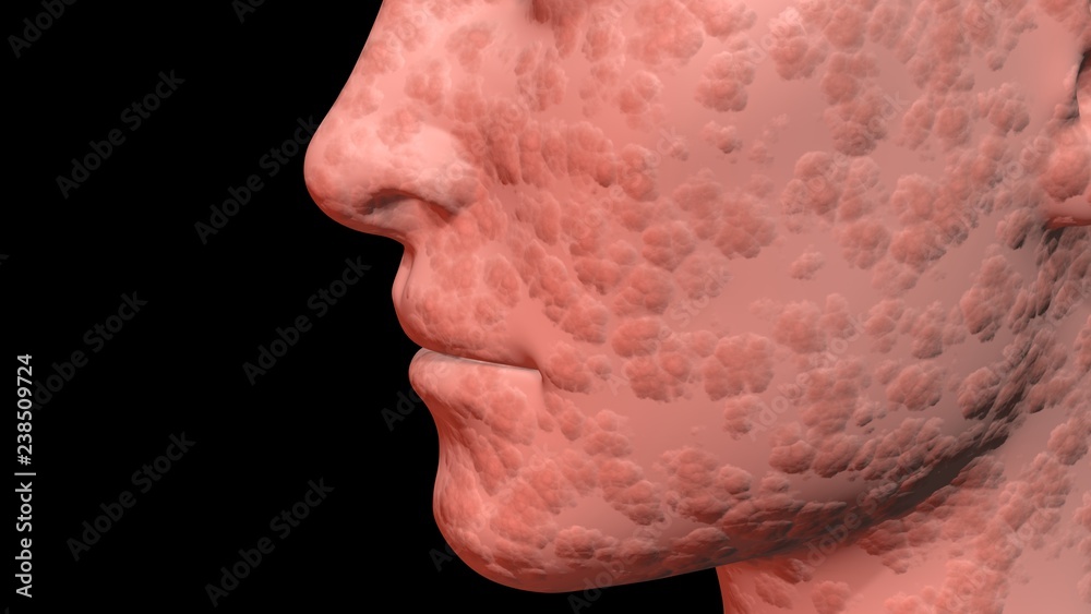 Skin Problems : Acne, pimples , infection on face. 3d rendering Stock ...