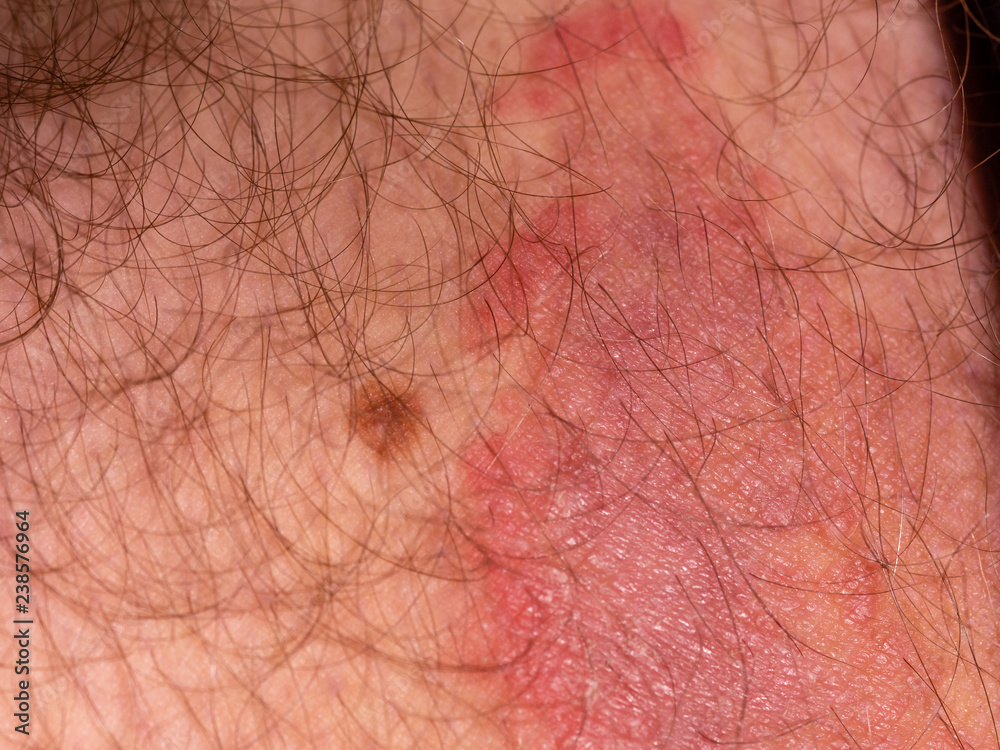 Fungal infection on skin of male leg Stock Photo | Adobe Stock