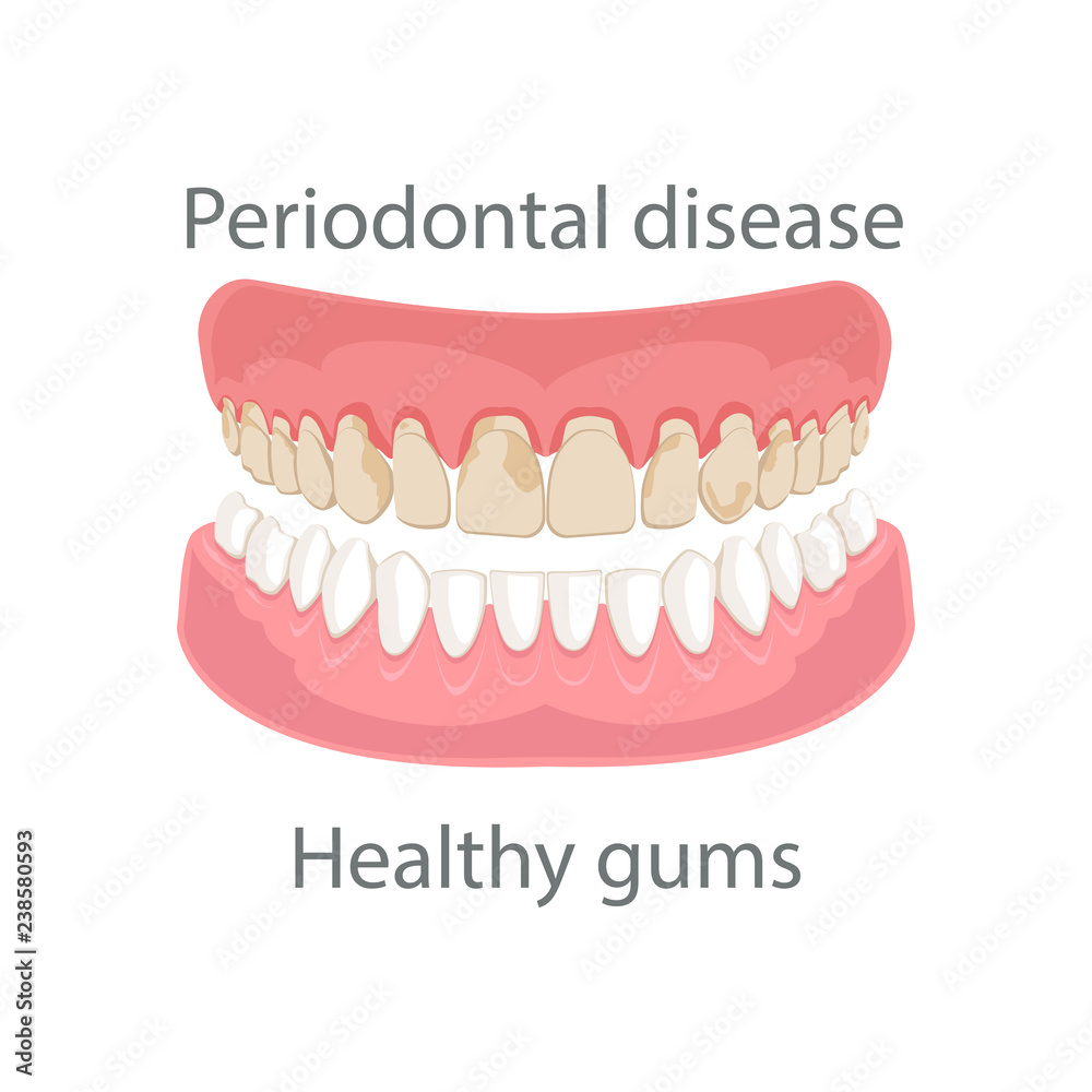 Dental Concept Gum Treatment Gum Disease And Teeth Periodontal dental-concept-gum-treatment-gum-disease-and-teeth-periodontal