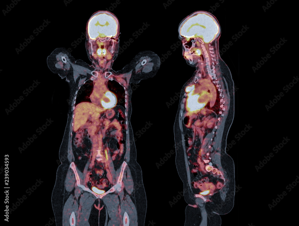 PET CT image of Whole human body coronal and sagittal plane. Positron ...