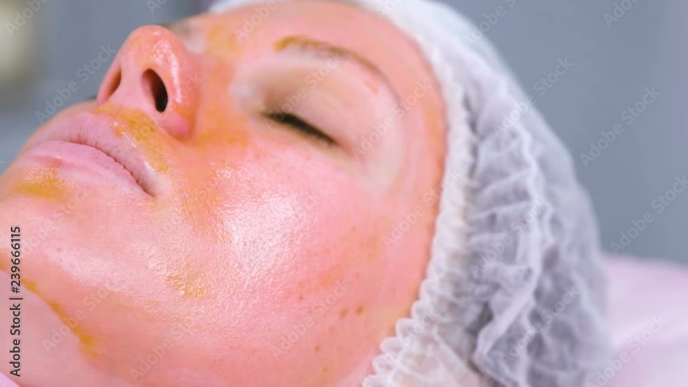 Chemical peeling o the woman's face. Cleaning the face skin and ...