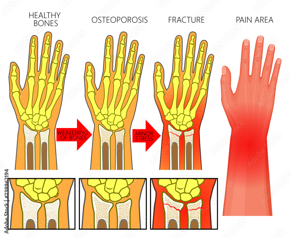 Vector illustration of a healthy human arm, with osteoporotic injury ...