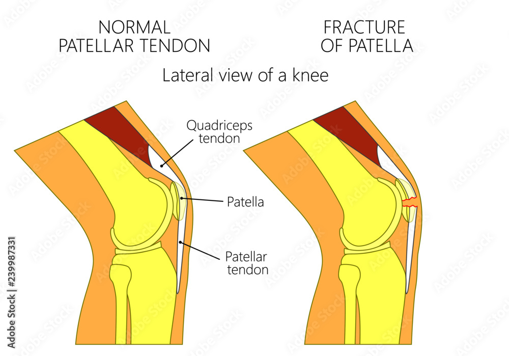 Vector illustration of a healthy knee joint and an unhealthy knee with ...