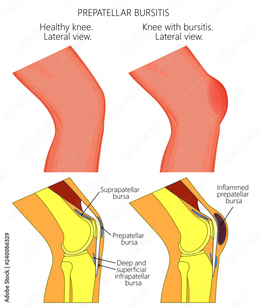 Vector illustration of a healthy knee and unhealthy knee with ...