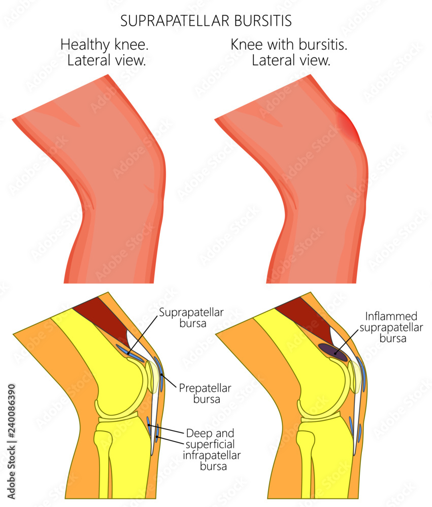 Vector illustration of a healthy knee and unhealthy knee with ...